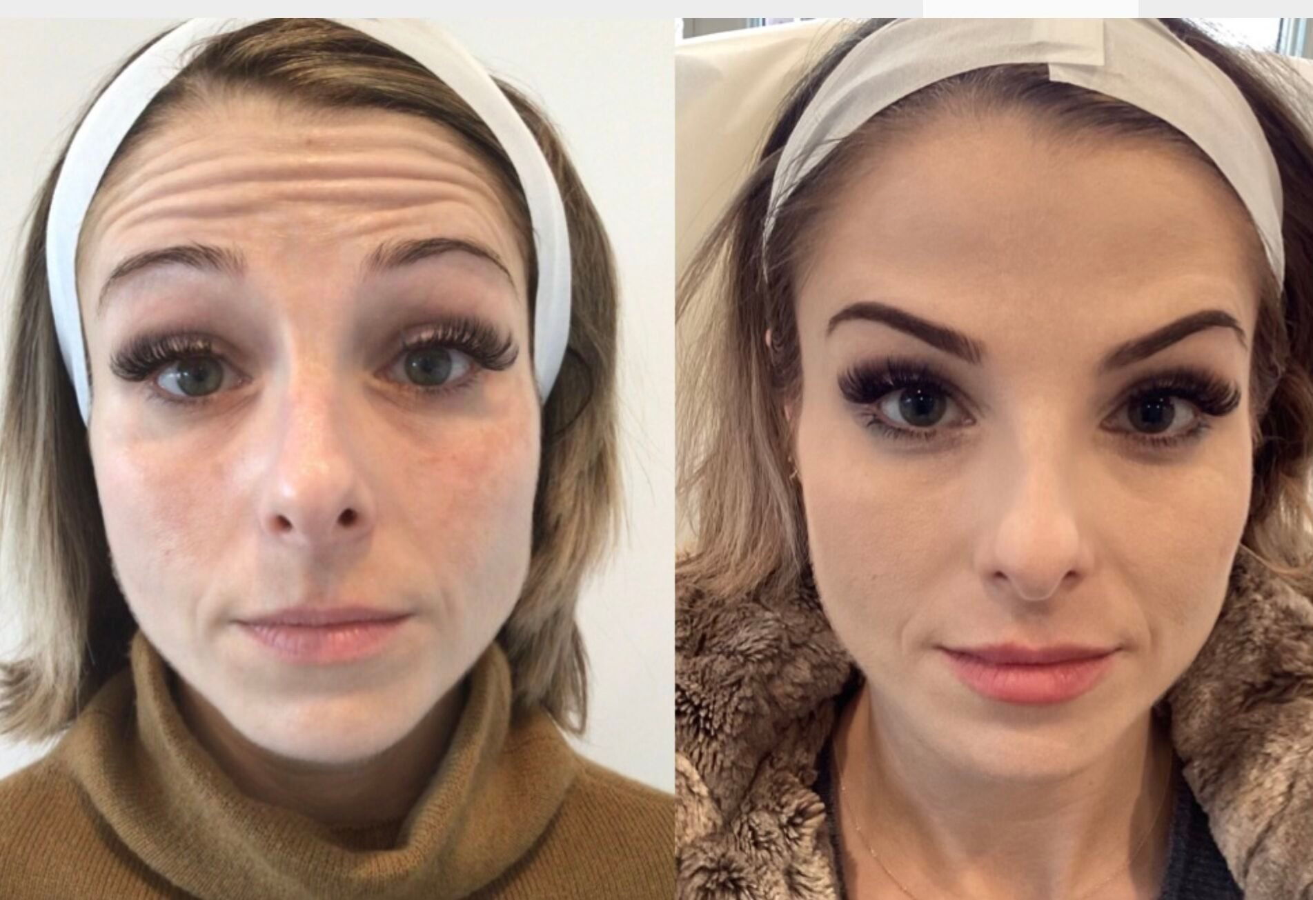 Fillers vs. Botox: Understanding Their Unique Roles in Facial ...
